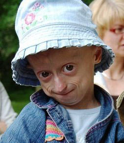 Welkom Progeria Family Circle